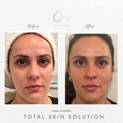 Total Skin Solution Patient 2 - Ona Skincare